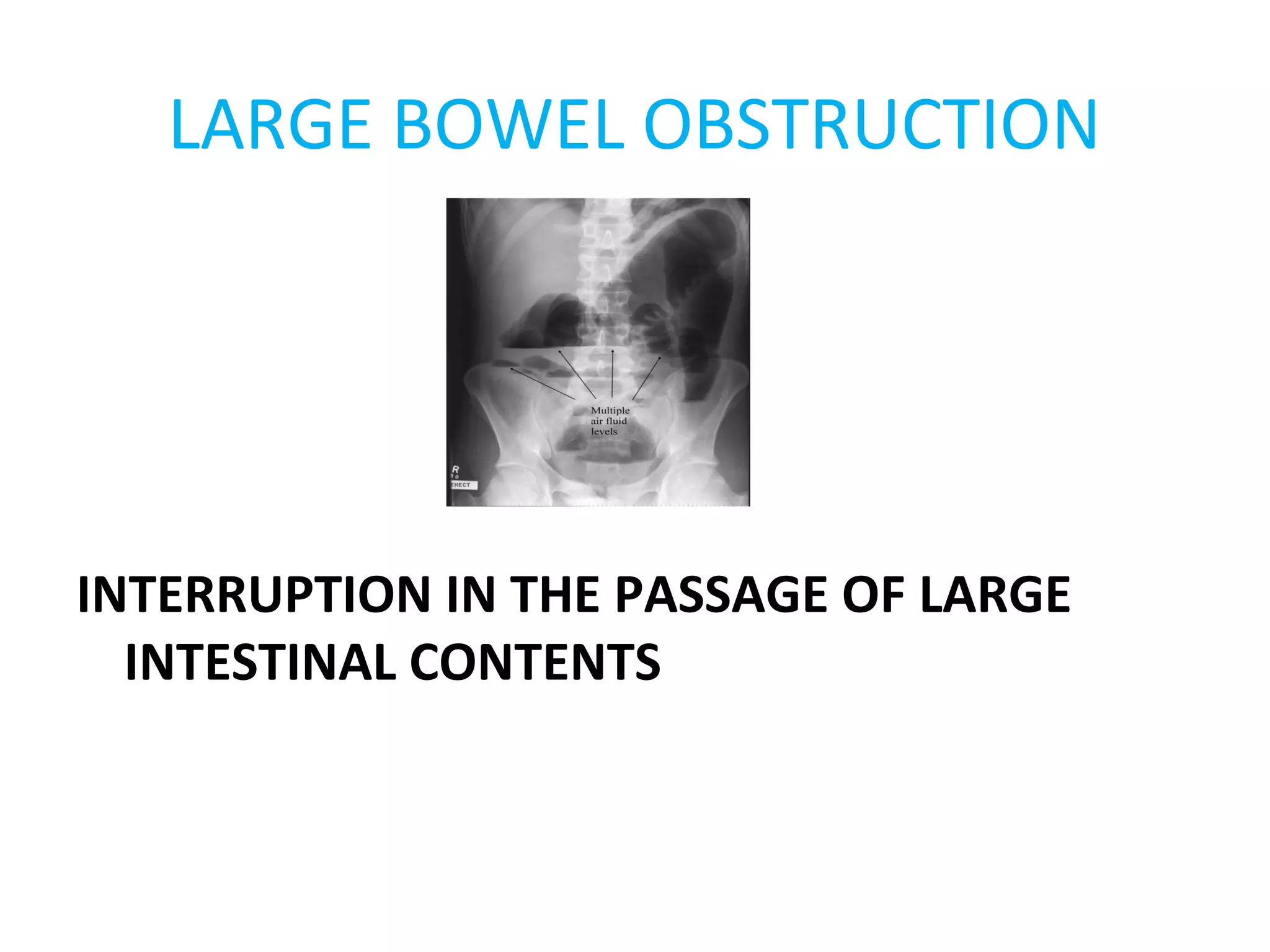 Large bowel obstruction -dr.p.saravanakumar ms pg tanjore medical ...