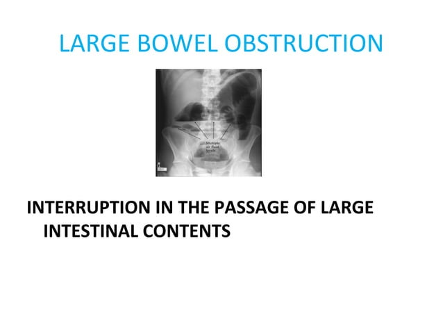Large bowel obstruction -dr.p.saravanakumar ms pg tanjore medical ...
