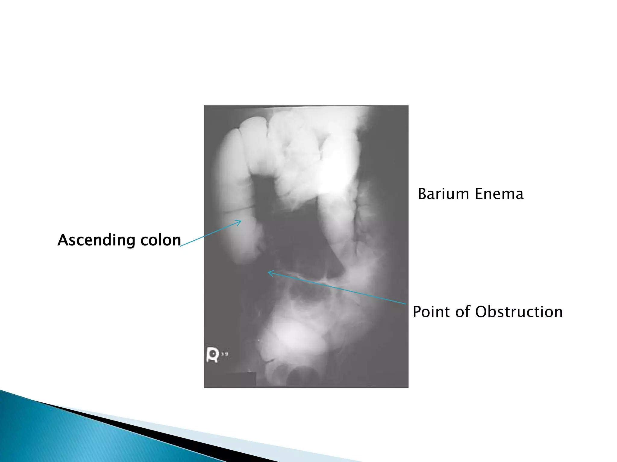 Large bowel obstruction | PPTX