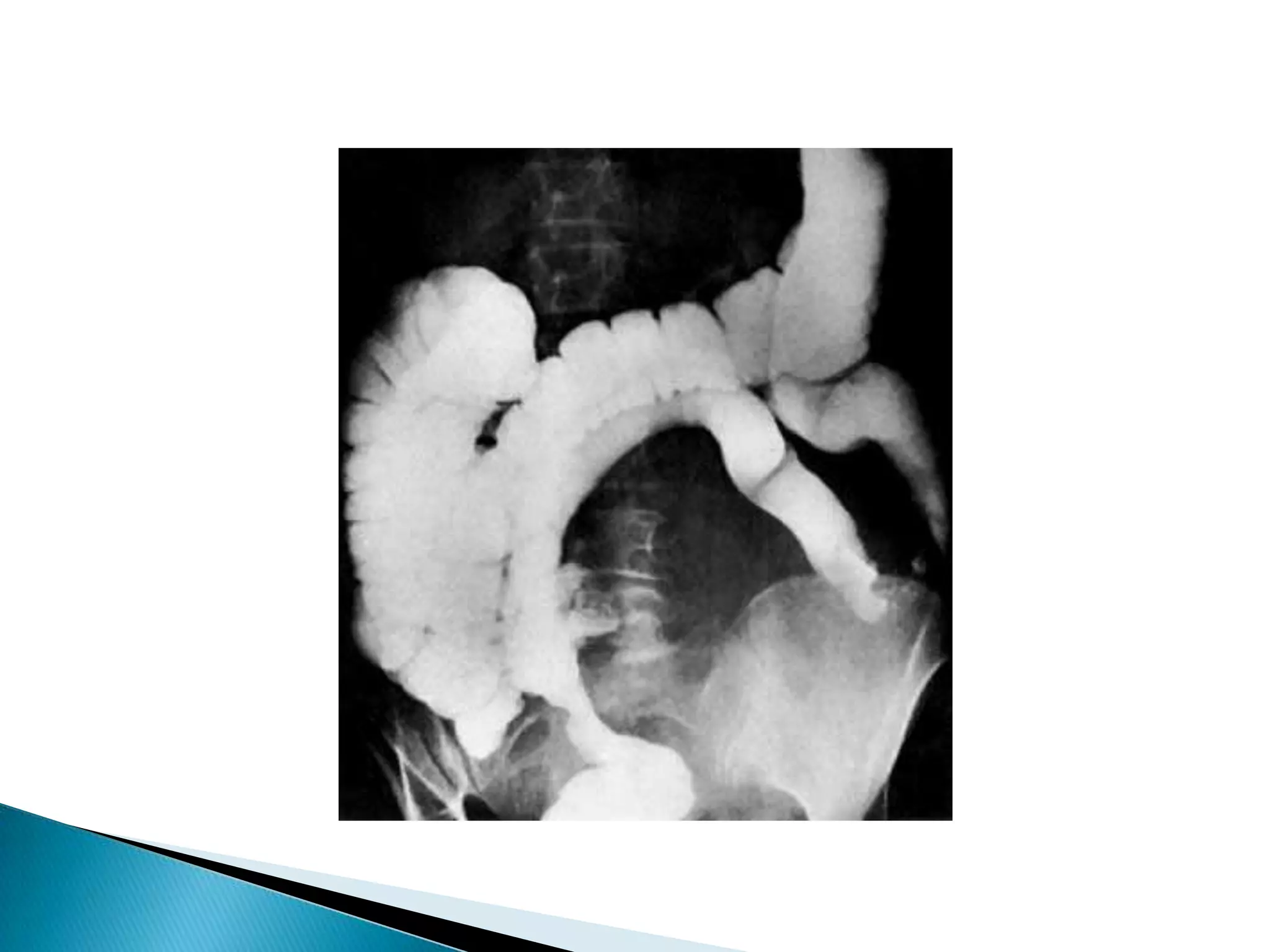 Large bowel obstruction | PPTX