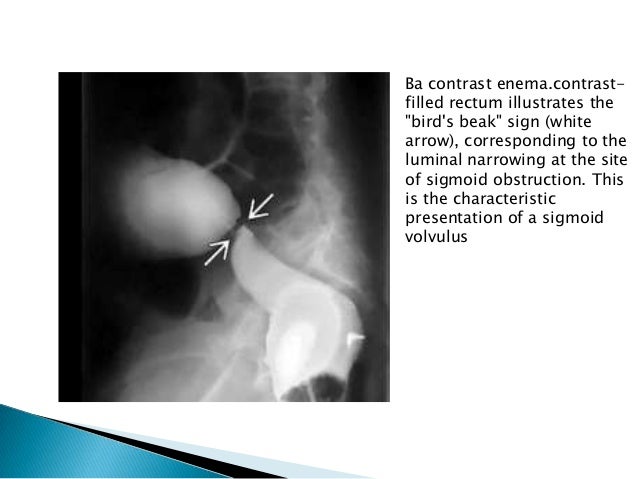 Large bowel obstruction
