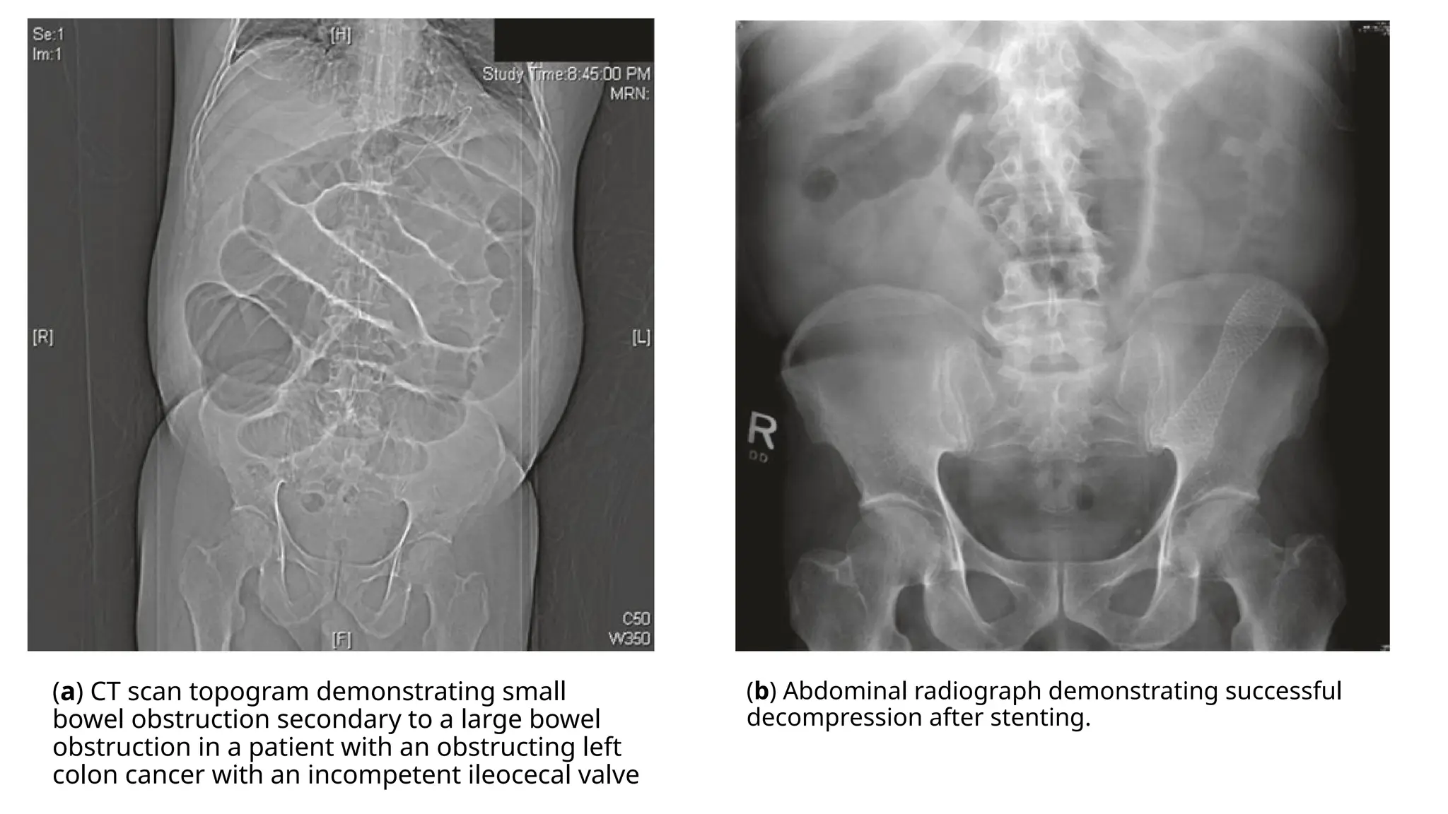 Large Bowel Obstruction- Evaluation and Management .pptx