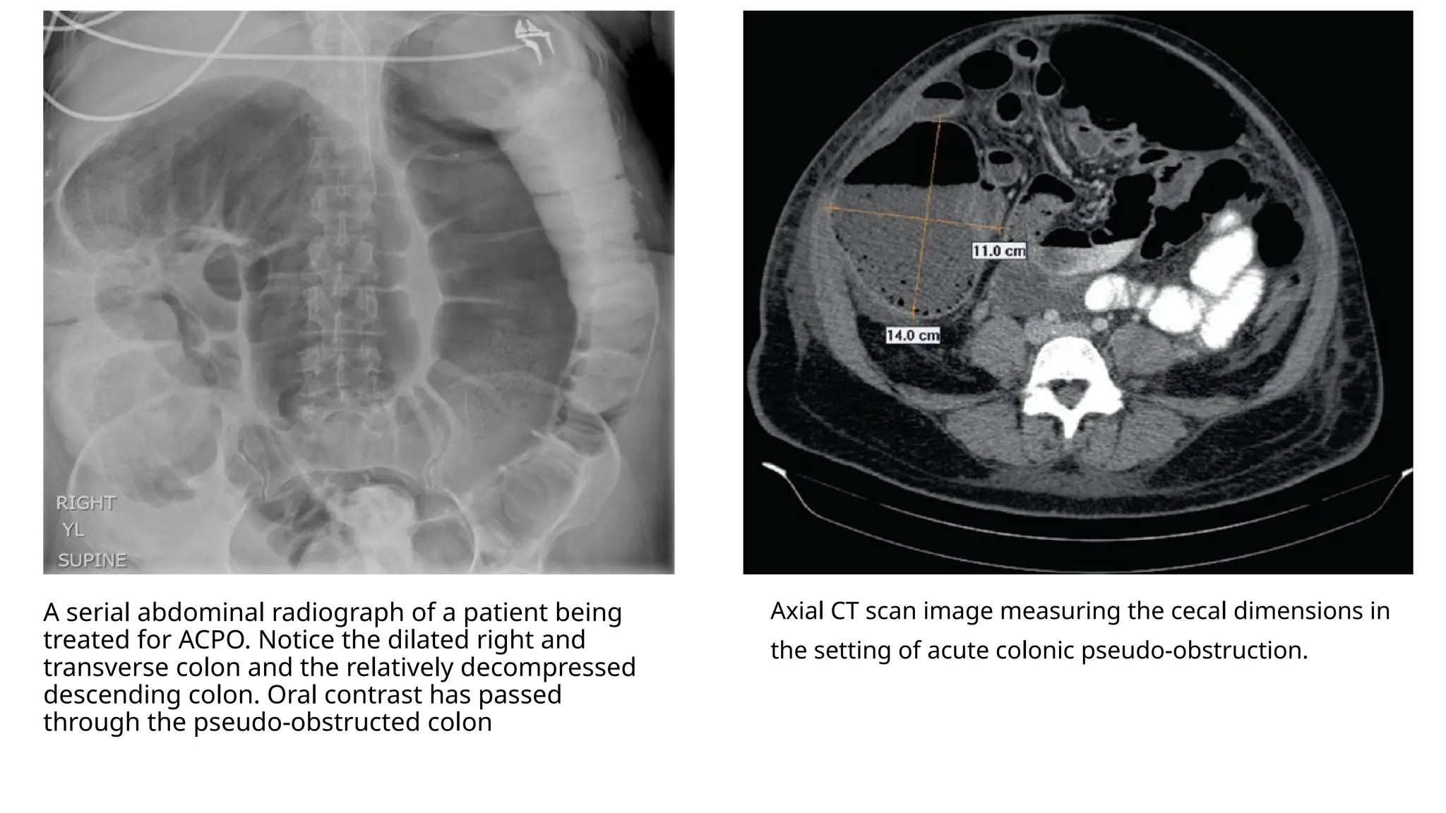 Large Bowel Obstruction- Evaluation and Management .pptx
