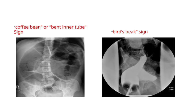 Large Bowel Obstruction- Evaluation and Management .pptx