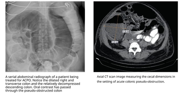 Large Bowel Obstruction- Evaluation and Management .pptx