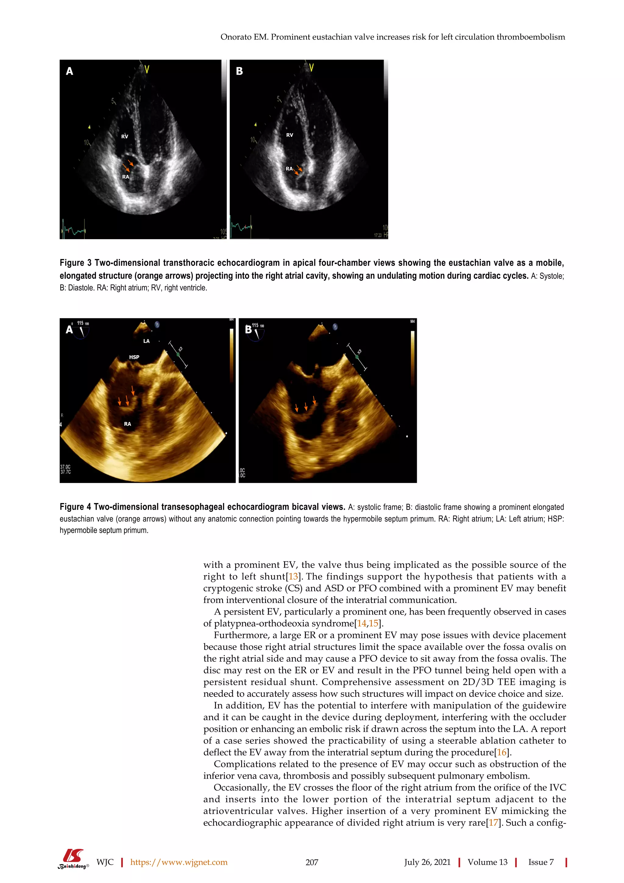 Large eustachian valve fostering paradoxical thromboembolism | PDF