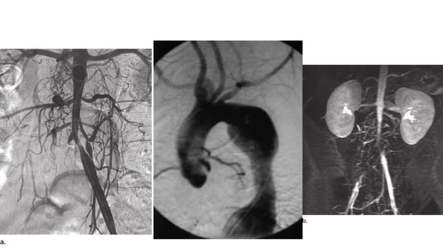LARGE VESSEL VASCULITIS- gca, takayasu arteries | PPT