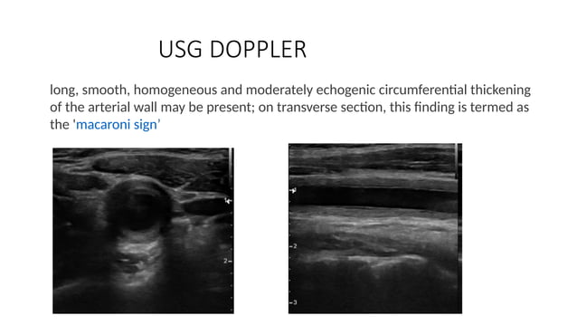 LARGE VESSEL VASCULITIS- gca, takayasu arteries | PPT