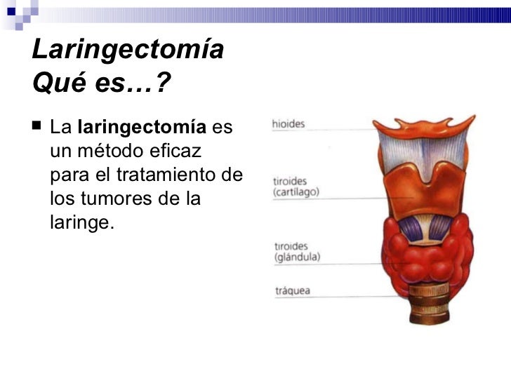 Laringectomía