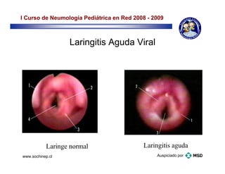Laringitis | PDF