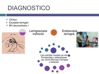 Laringitis | PPTX