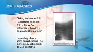 Laringitis PEDIATRIA | PPTX