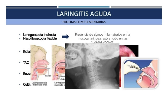 Laringitis aguda