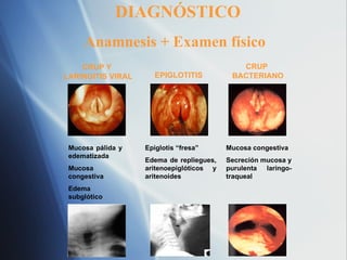 Laringitis Aguda Pre Grado | PPT