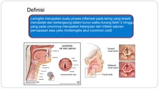 LARINGITIS_AKUT.ppt