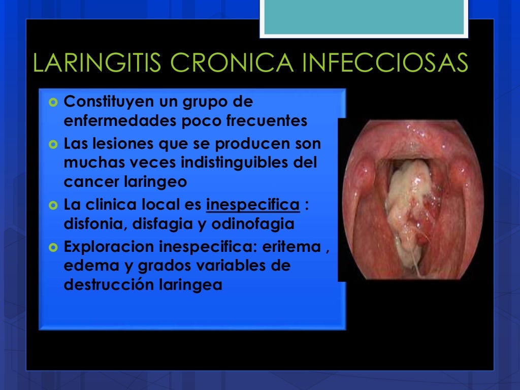 Laringitis cronica