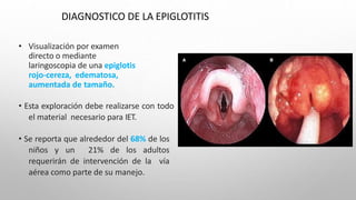 laringitis, crup viral, epiglotitis .pptx