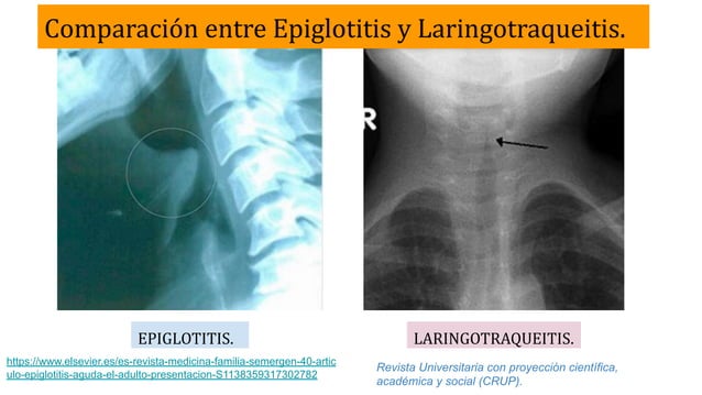 Laringitis Epiglotitis Y Bronquiolitis Pdf