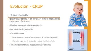 Laringitis infecciosas eva | PDF