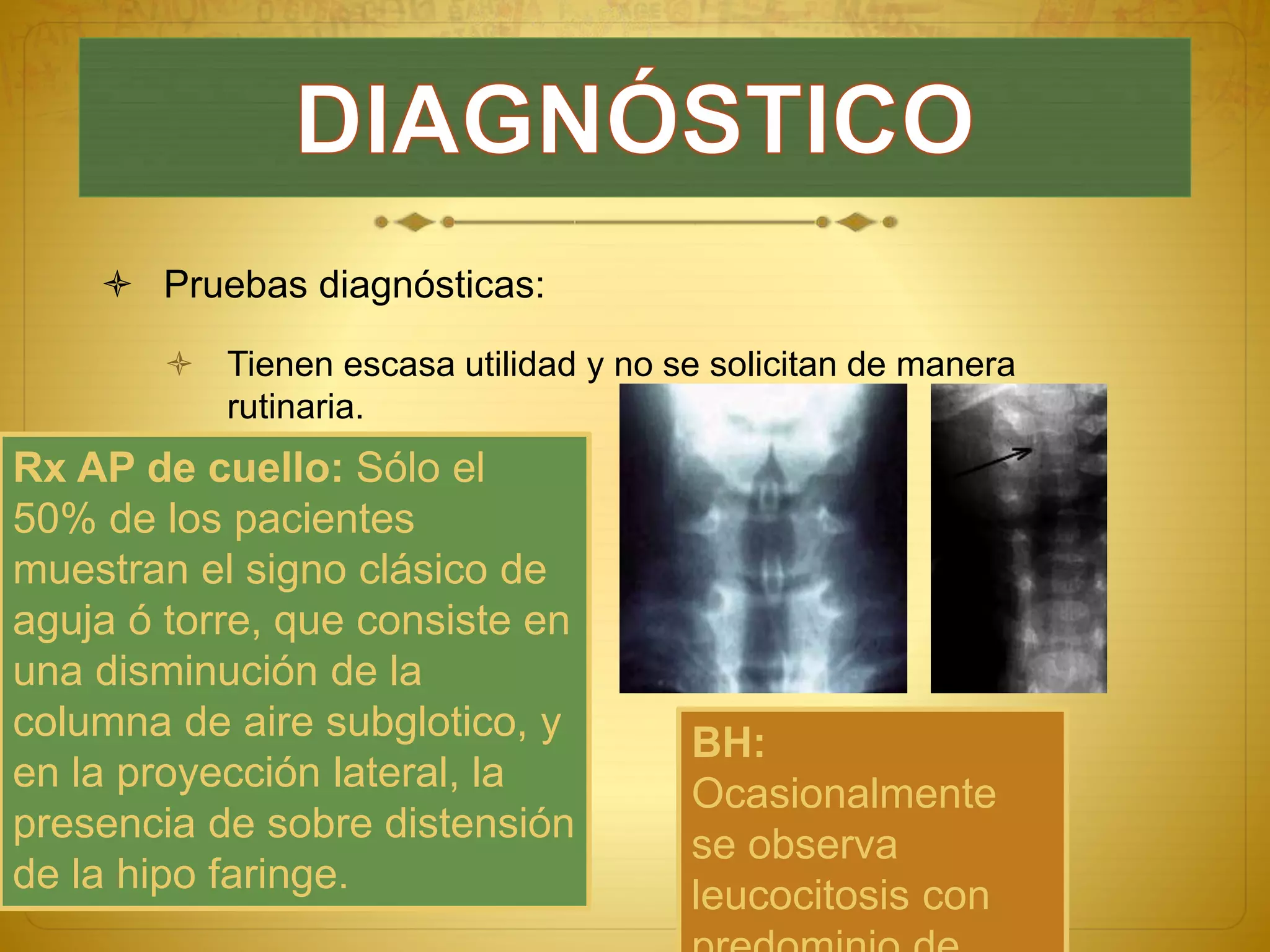 CRUP: Laringitis Pediatría | PPTX