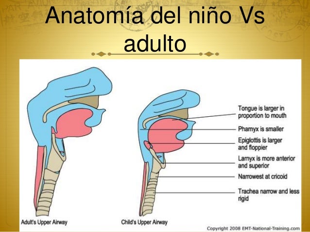 CRUP: Laringitis Pediatría