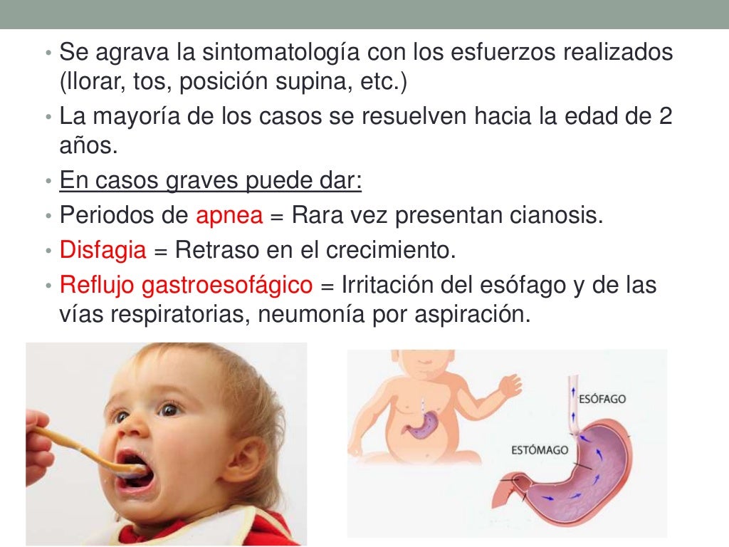 Laringomalacia