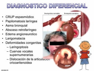 LARINGOTRAQUEITIS | PPT