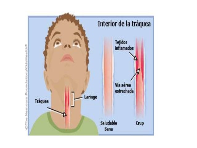 Laringotraqueitis aguda