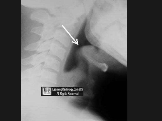 Laringotraqueitis Aguda (CRUP)