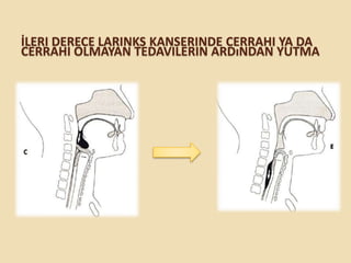 Larinks kanseri vaka inceleme sunumu ve beslenme tedavisi | PPTX