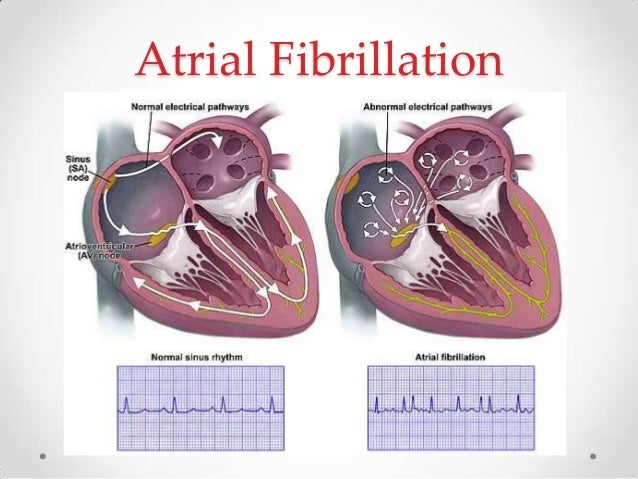 Dabigatran for Atrial Fibrillation: Cardioversion and Ablation