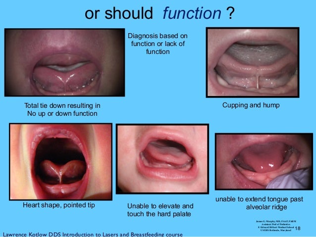 Larry-kotlow-spreecast-frenectomy-july-2013