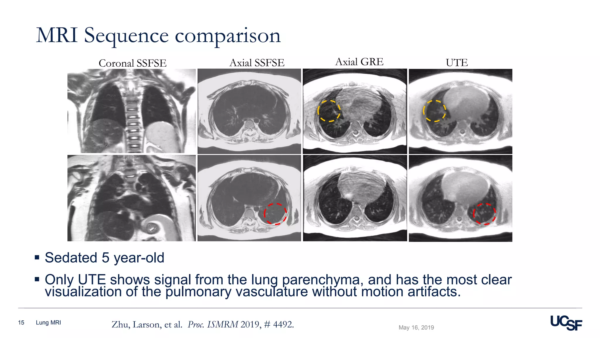 Lung MRI | PDF