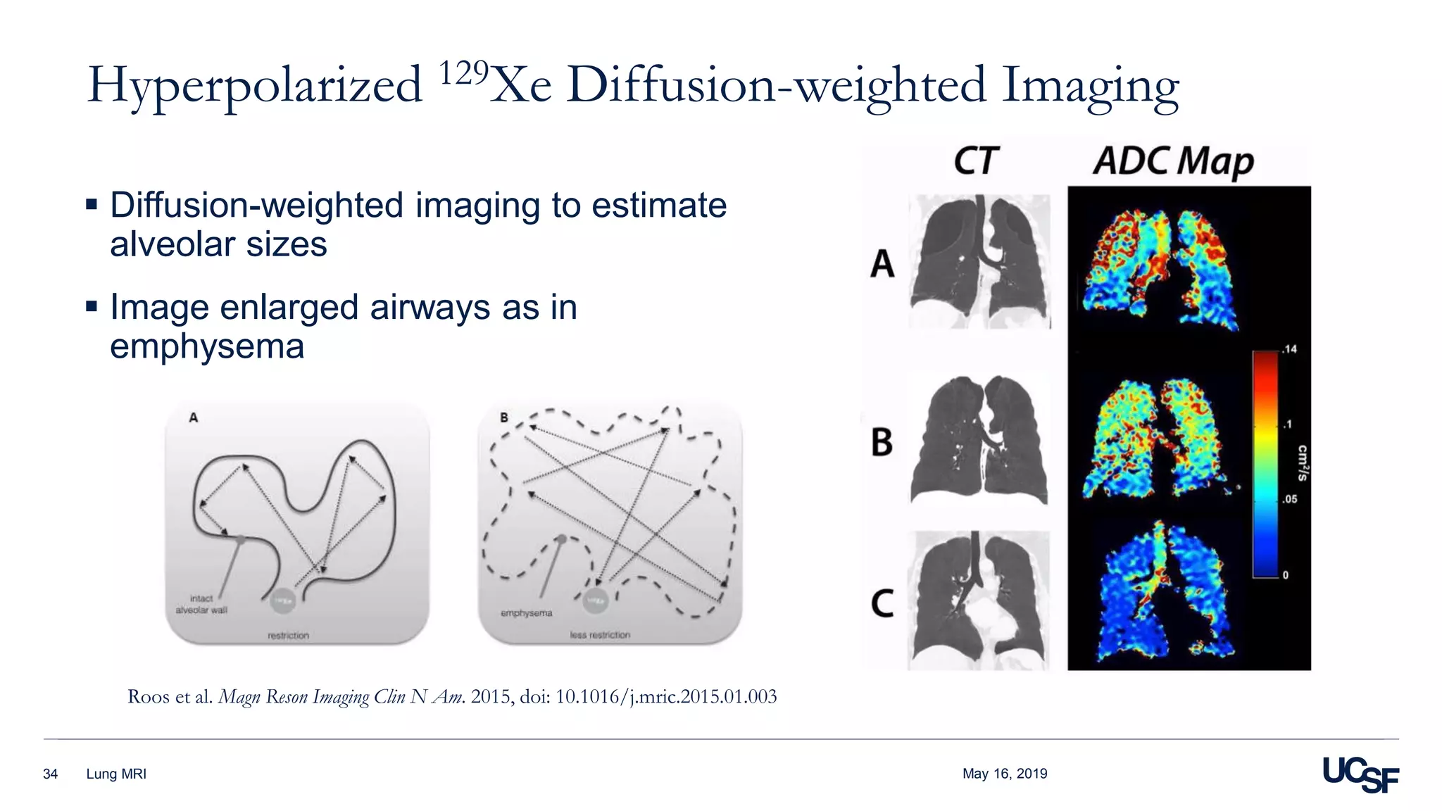 Lung MRI | PDF