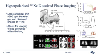 Lung MRI | PDF