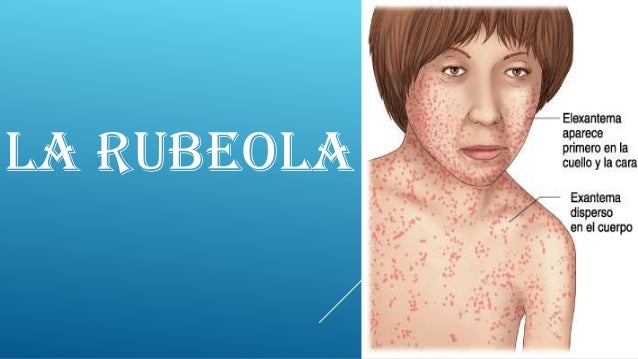 La rubeola ppd