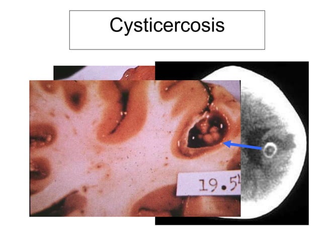 Larval cestodes who cause diseases to humans | PPT