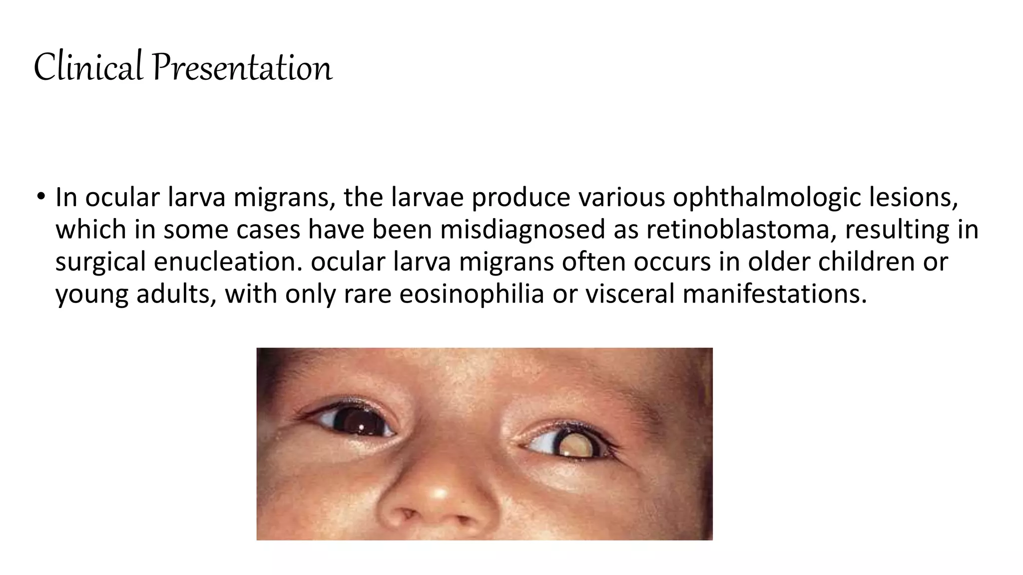 Larva migrans | PPTX