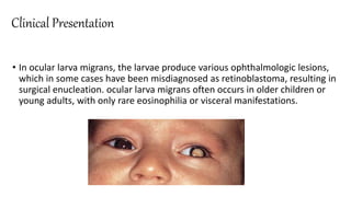 Visceral Larva Migrans