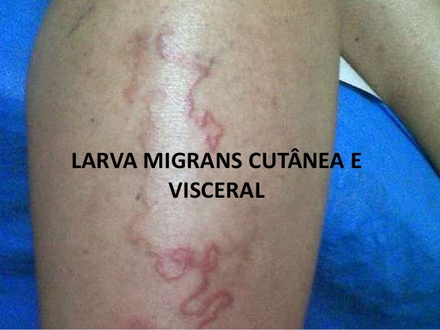 Larva migrans cutânea e visceral