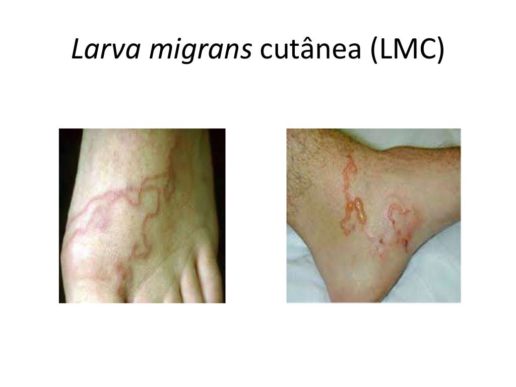 Larva migrans cutânea e visceral