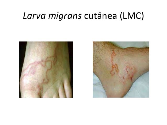 Larva migrans cutânea e visceral