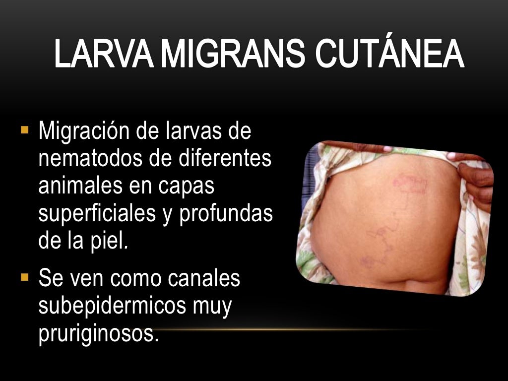 Larva migrans cutánea y visceral