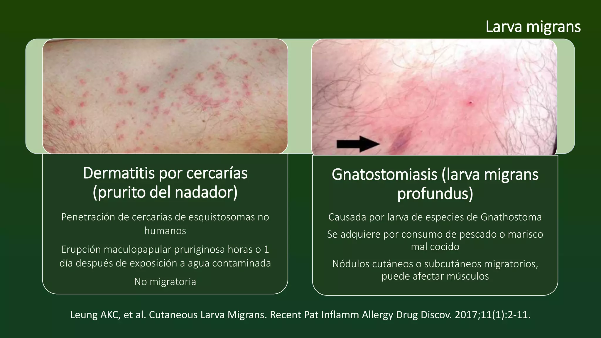 Larva Migrans | PPTX