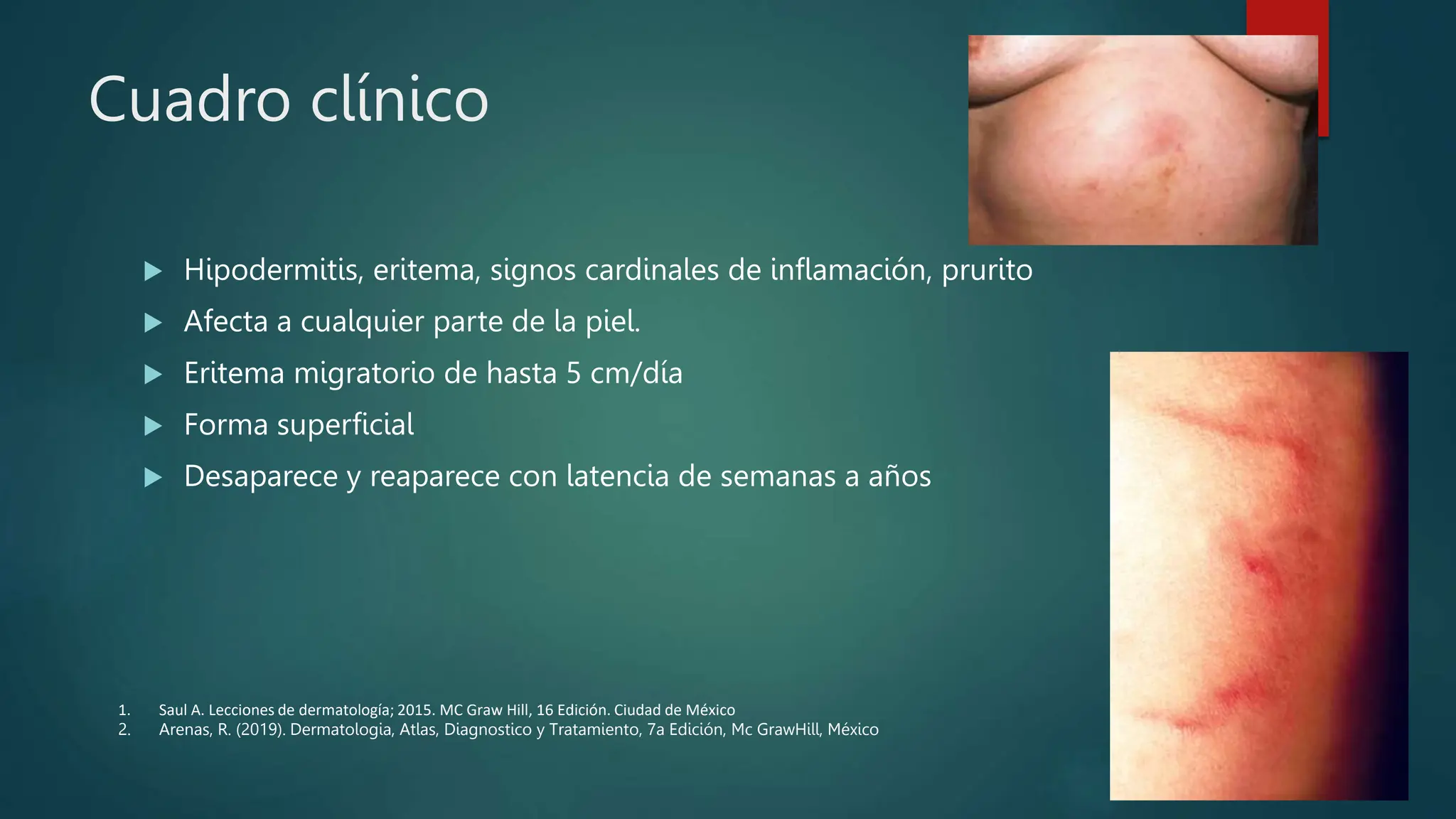 LARVA MIGRANS Y GNATHOSTOMIASIS DERMATOLOGIA | PPTX
