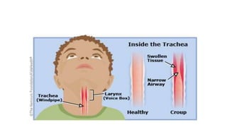 Laryng0 tracheal bronchitis (croup). | PPTX