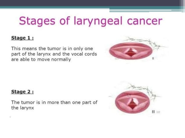LARYNGEAL CANCER.pptx Prepared by Neha Kewat | PPT
