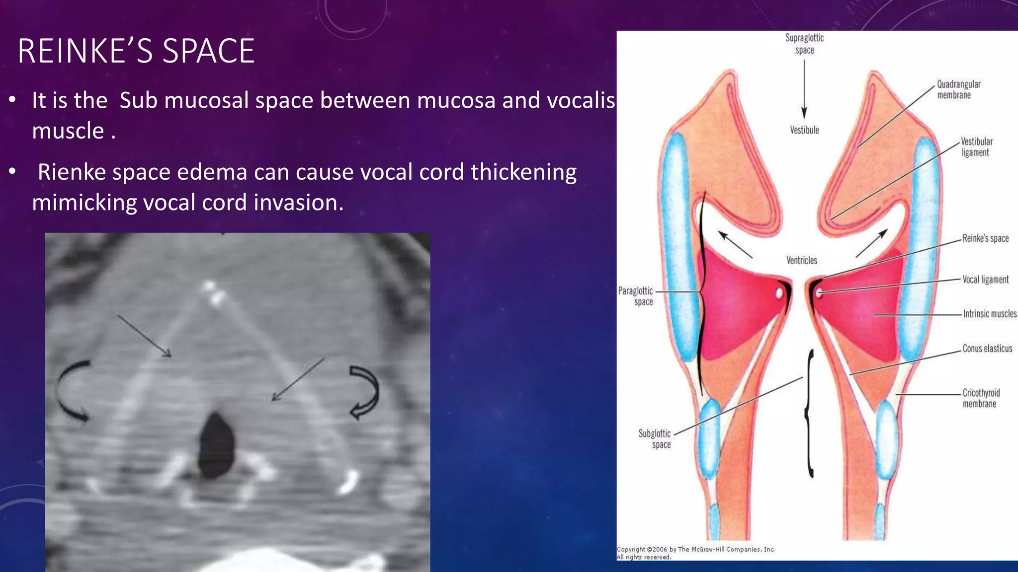 Laryngeal carcinoma Imaging | PPTX