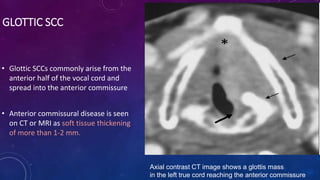 Laryngeal carcinoma Imaging | PPTX