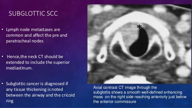 Laryngeal carcinoma Imaging